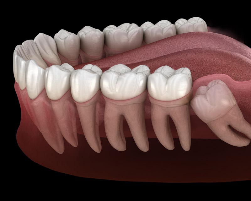 Dental Implant Placement & Wisdom Teeth Removal in Round Rock, TX ...